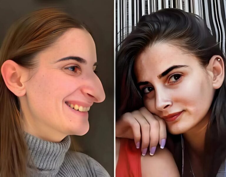 A girl with an unusual nose underwent plastic surgery: here's what she ...