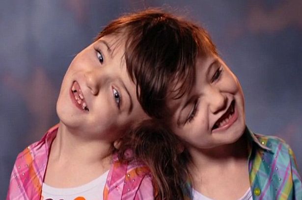 Two sisters born with their heads joined together were considered lost ...