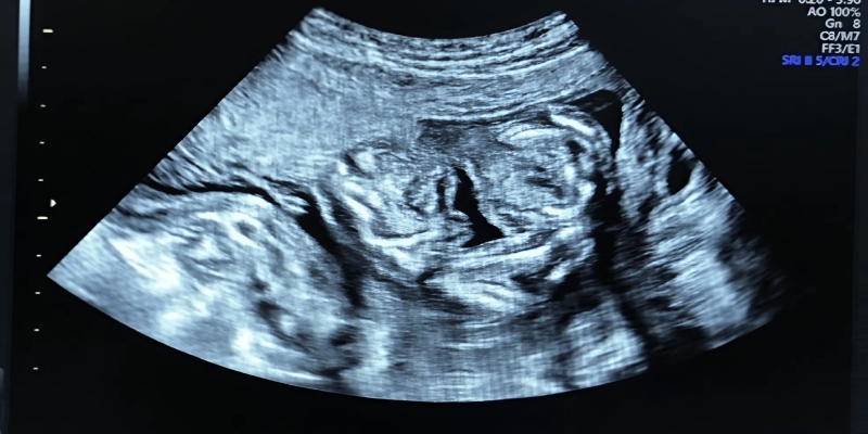 The incredible fate of twins conjoined at the head, which shocked ...