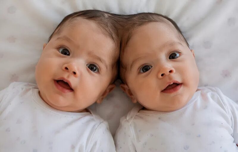 The incredible fate of twins conjoined at the head, which shocked ...